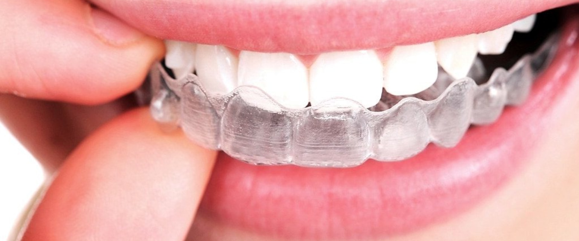 What Types of Insurance Plans Cover Invisalign Treatment from a Dentist?