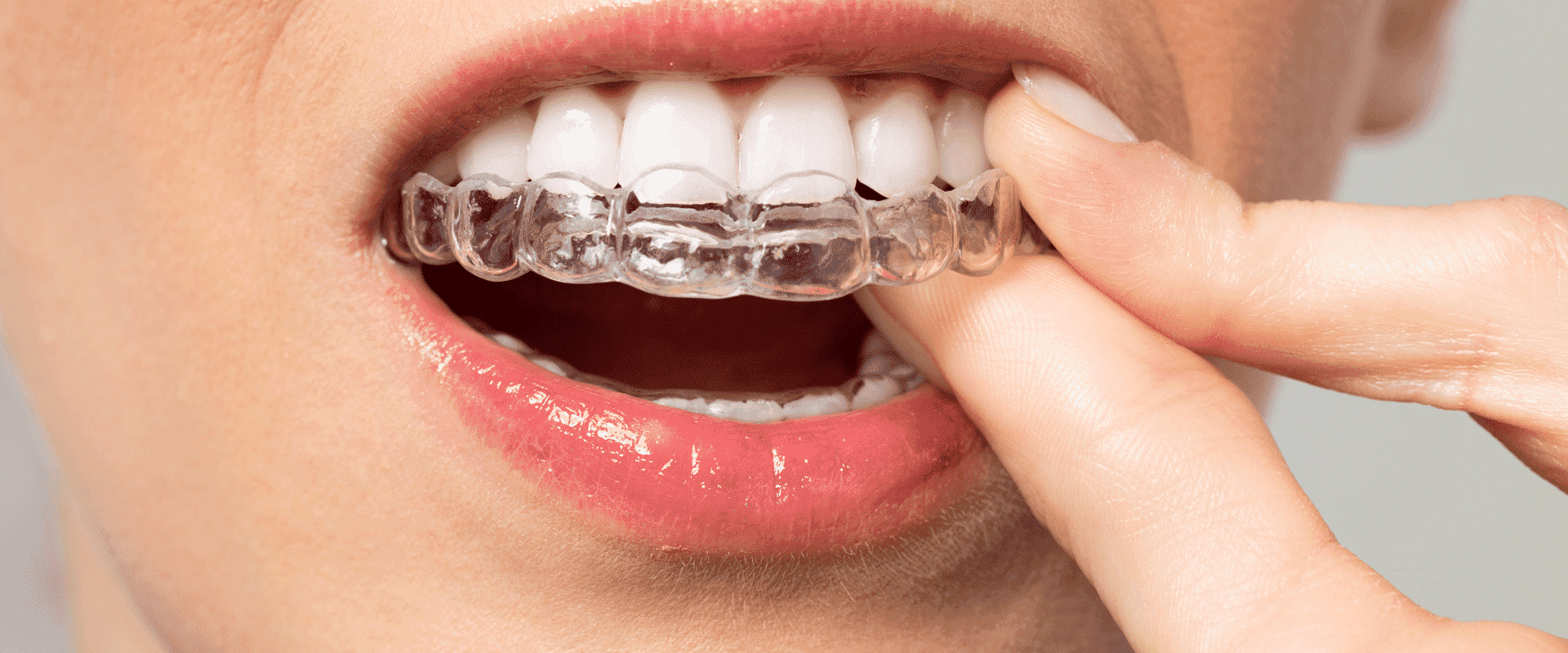 The Benefits Of Invisalign: Why More McGregor Residents Are Choosing ...