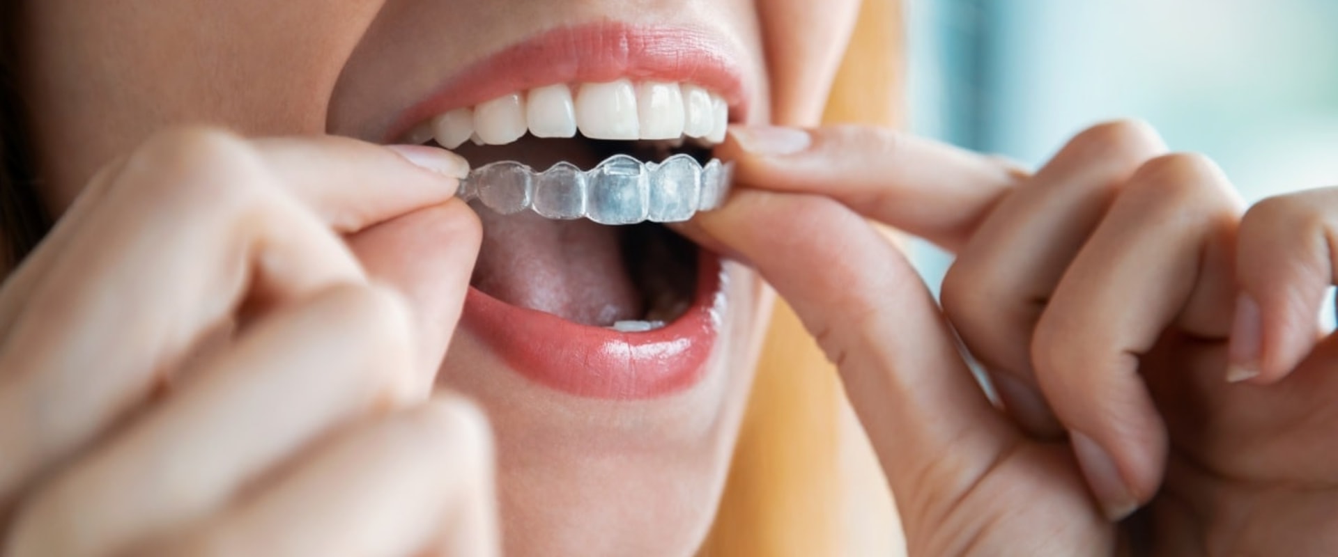 What To Look For When Searching For A Qualified Invisalign Dentist In ...