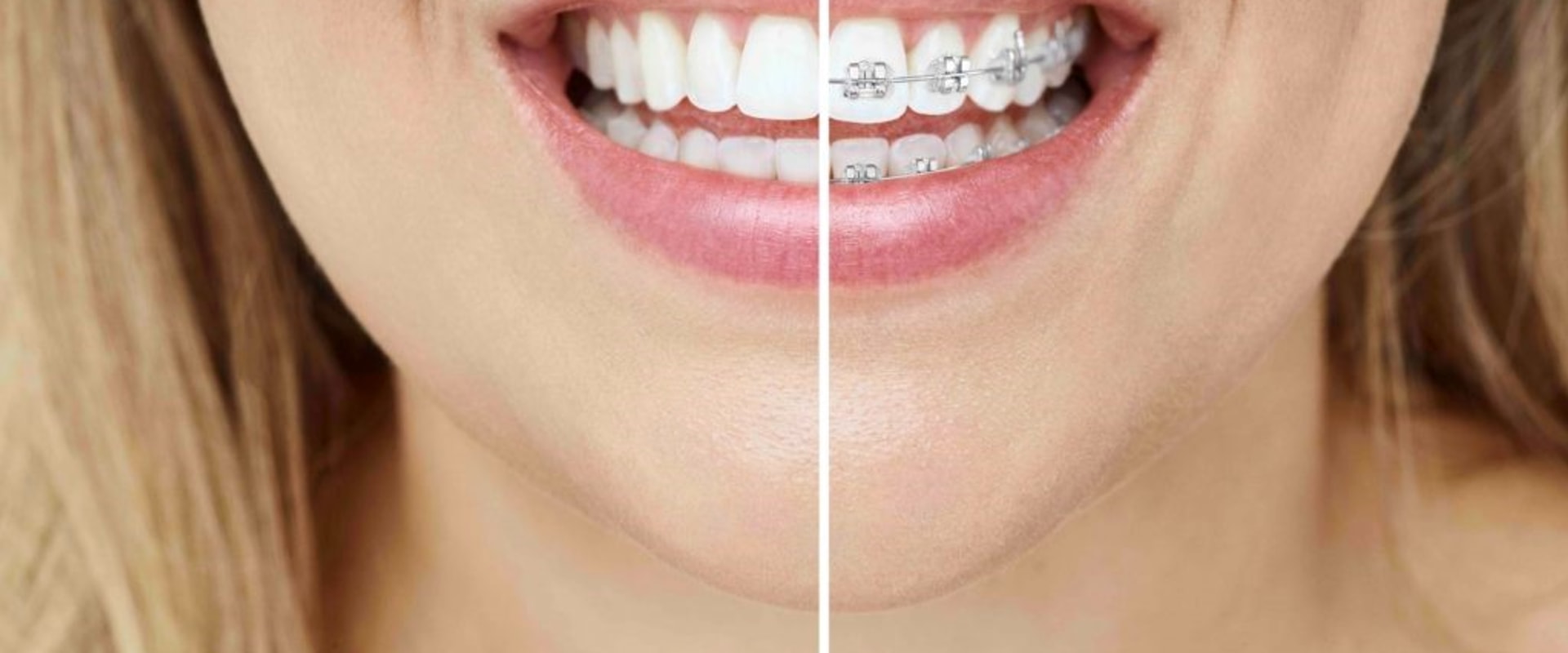 Straighten Your Teeth In Style With Invisalign: Meet Your Sydney ...