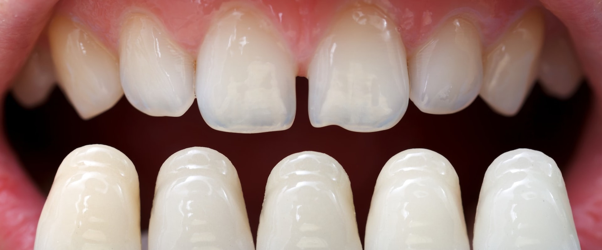 Are Porcelain Veneers Right For You? Find Out From Round Rock, TX's ...
