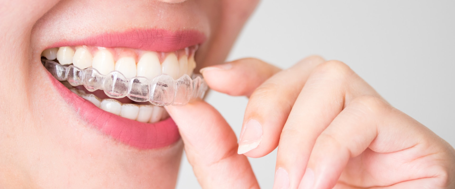 Can Invisalign Cause Fillings to Fall Out?