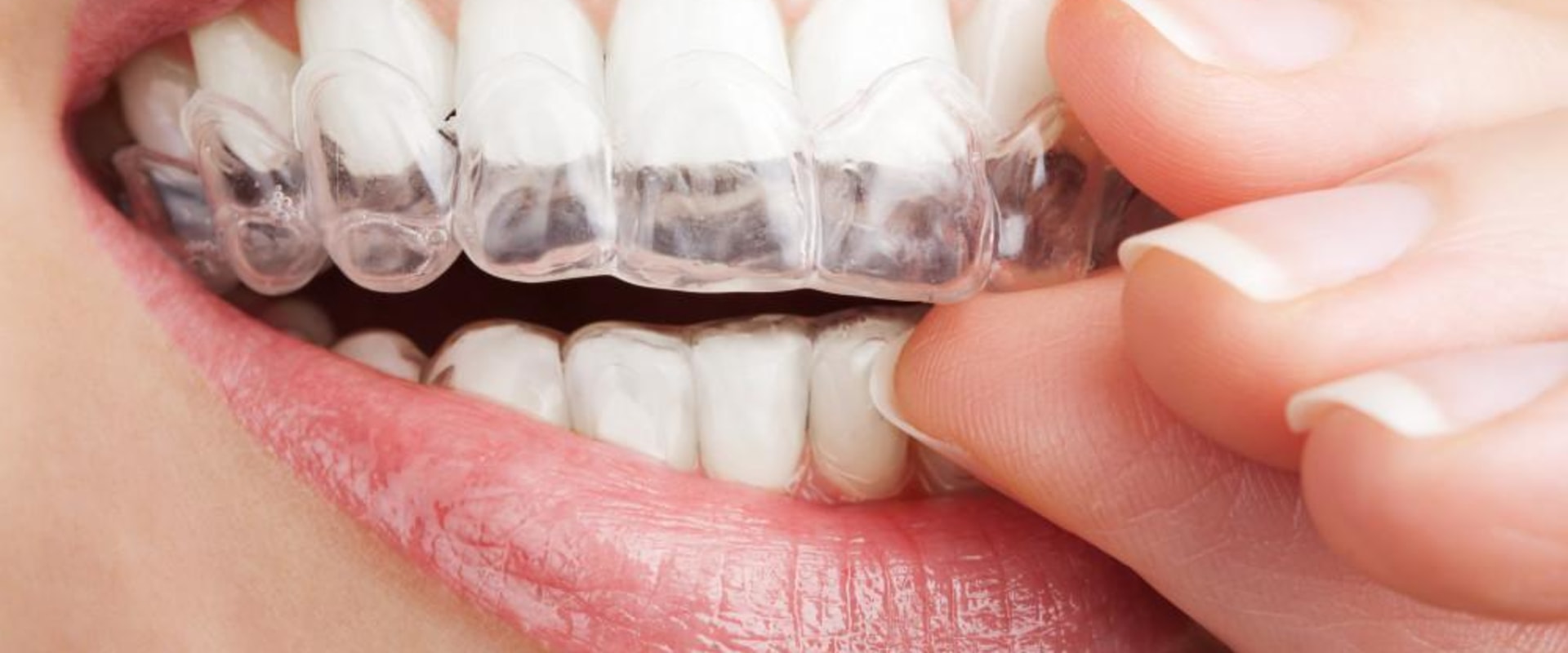 Can Invisalign Cause Root Damage? - An Expert's Perspective